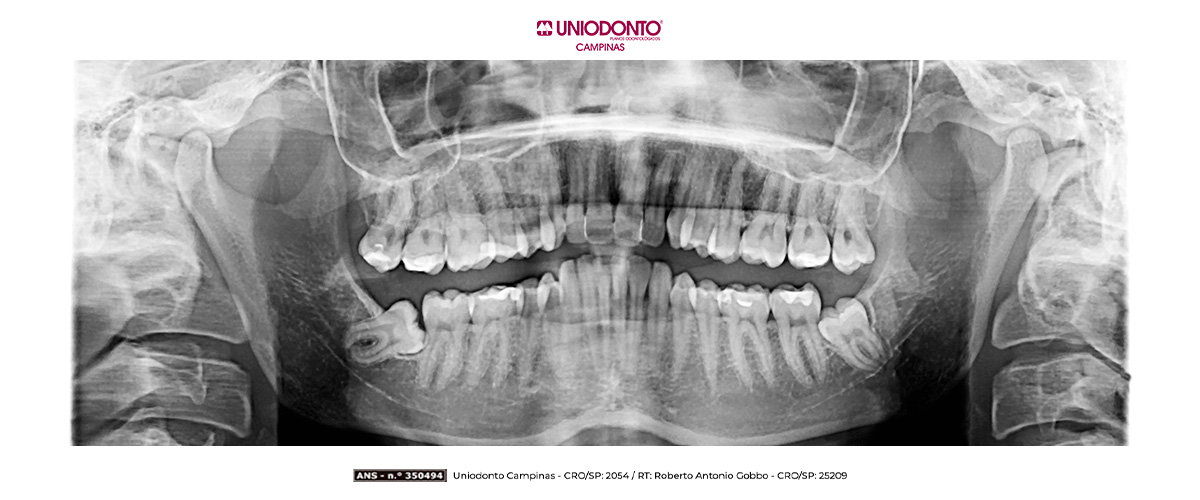 O que você precisa saber sobre displasia cleidocraniana - Uniodonto